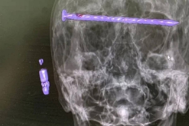 إزالة مسمار طويل من رأس رجل - جريدة الجريدة الكويتية